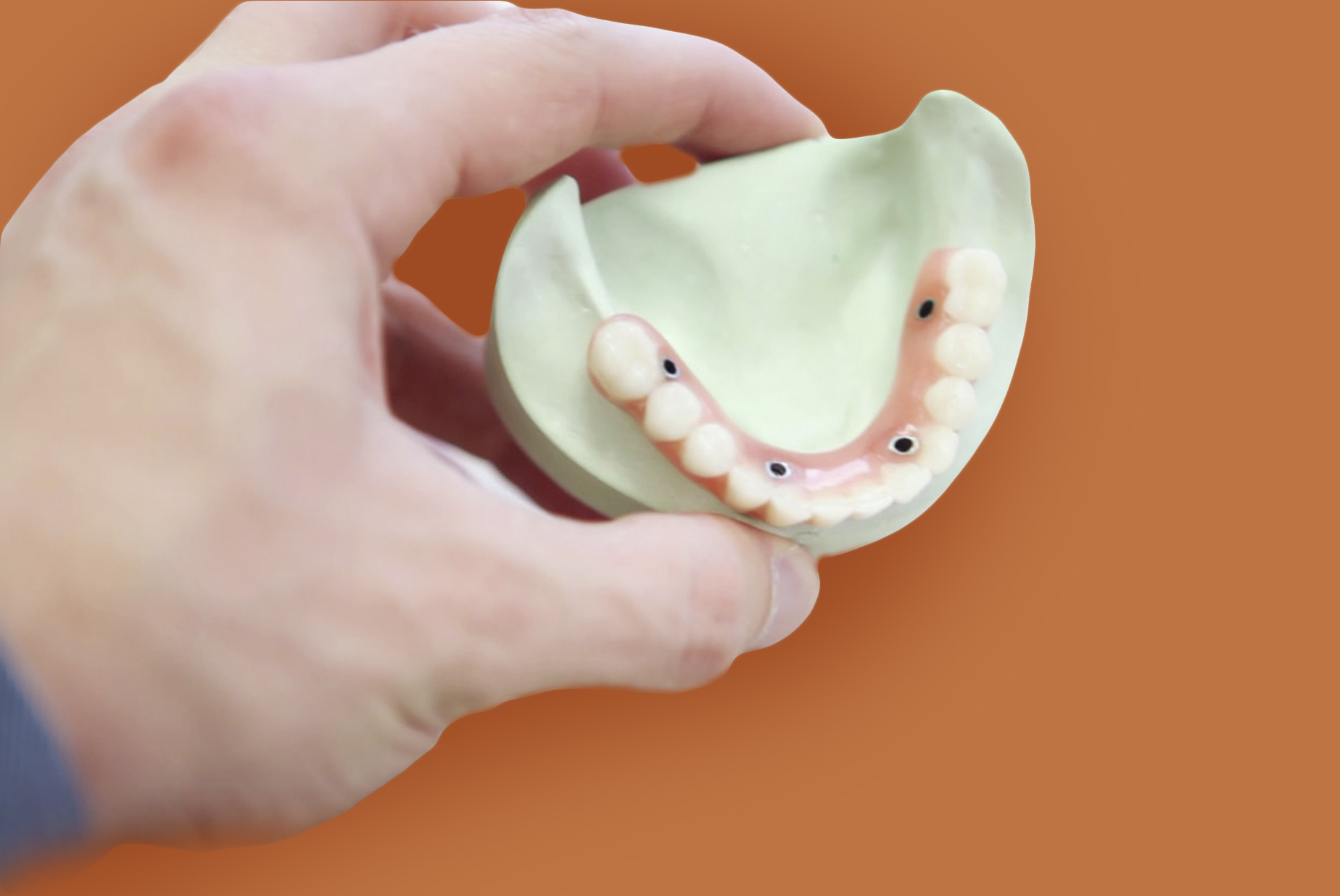 Dental Crowns and Bridges | Spark Dental | Mahogany Village Calgary